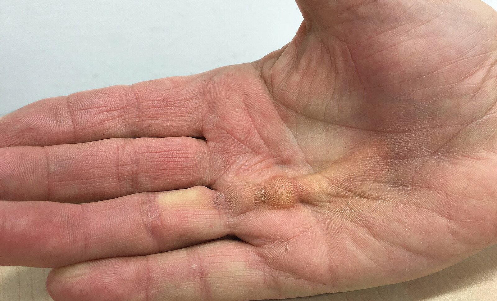 Wenn sich die Finger ungewollt krümmen